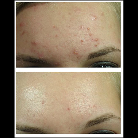 Acne Treatment San Antonio | SliMedica